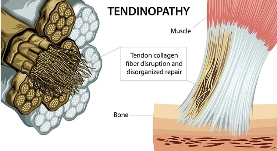 UNDERSTANDING THE DIFFERENCE: Tendinopathy, Tendinitis, and Tendinosis ...